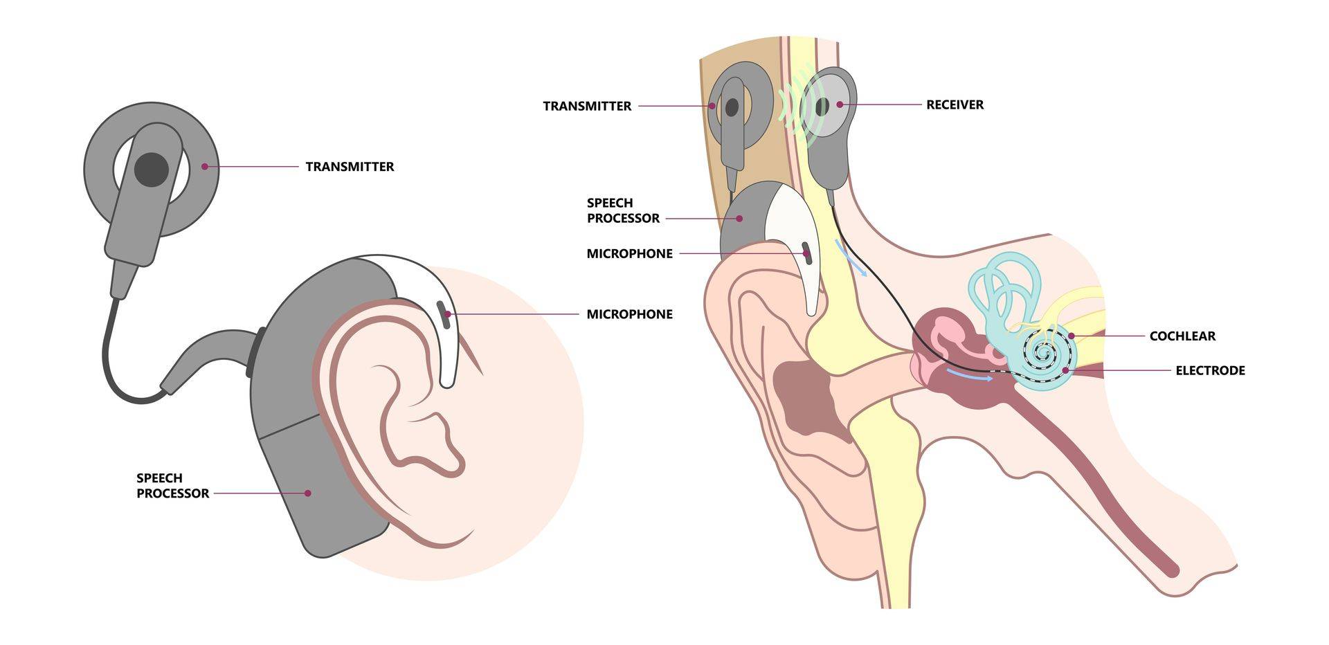 Cochlear Implant vs Hearing Aids: What’s the Difference? - The Hearing Room
